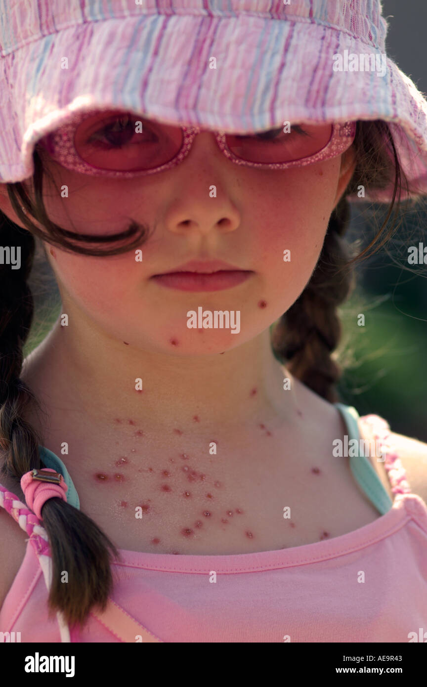 Girl chicken pox hi-res stock photography and images - Alamy