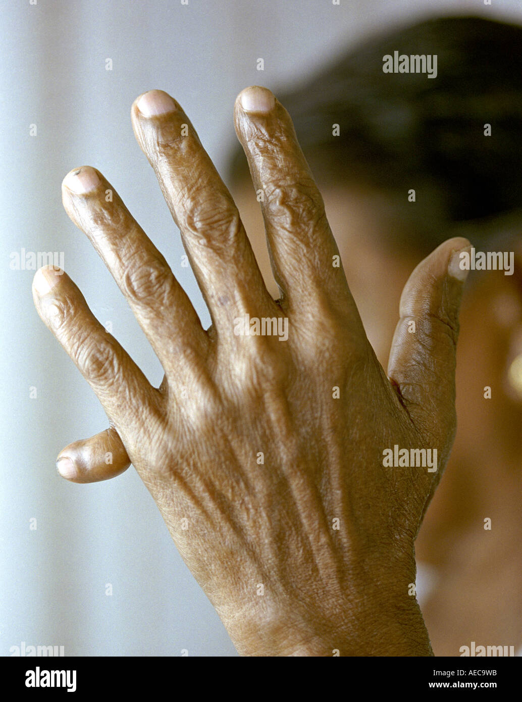 Polydactyly hi-res stock photography and images - Alamy