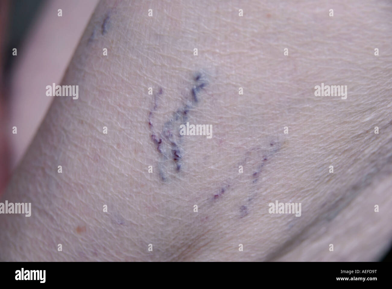 thread veins on a woman s leg Stock Photo - Alamy