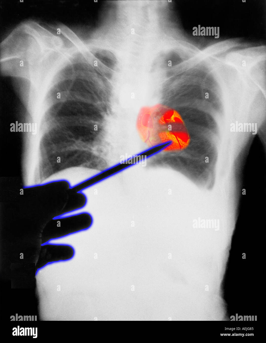 Concept of physician s hand pointing to heart on x ray Stock Photo - Alamy