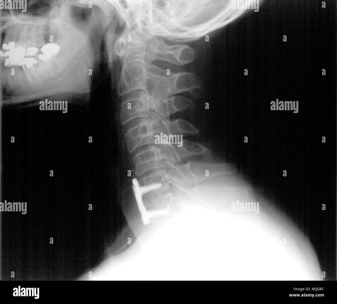 X ray of the neck Stock Photo - Alamy