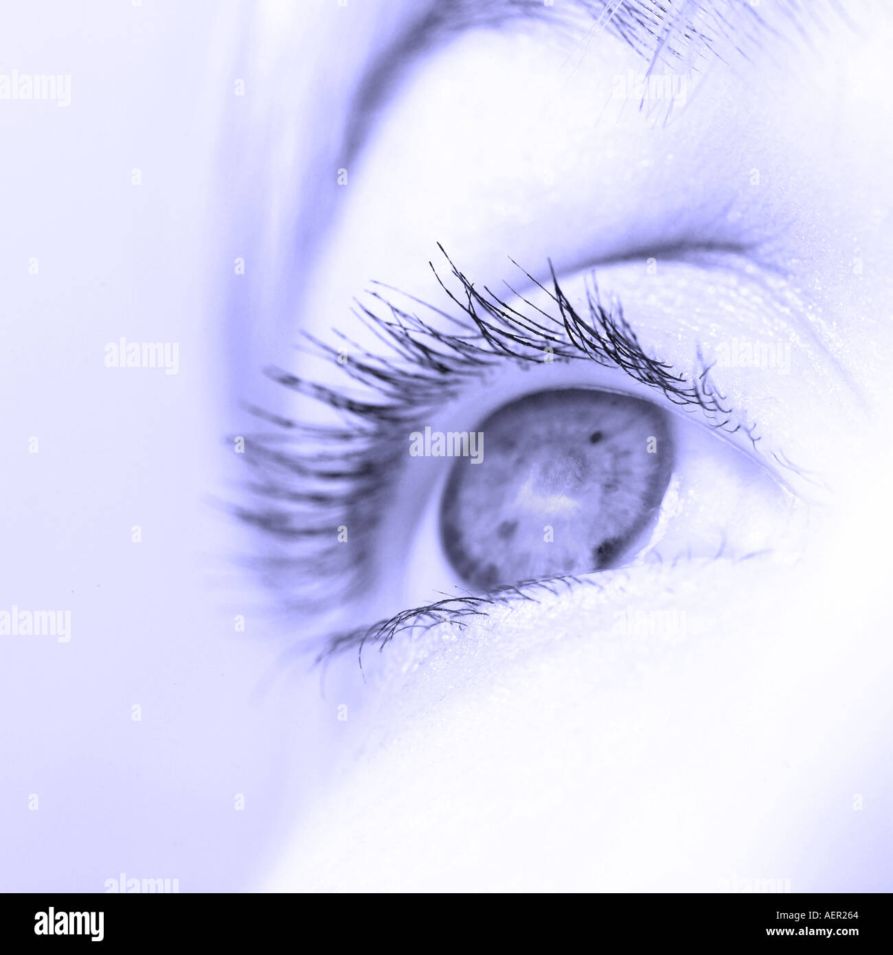 Upslanted Palpebral Fissure