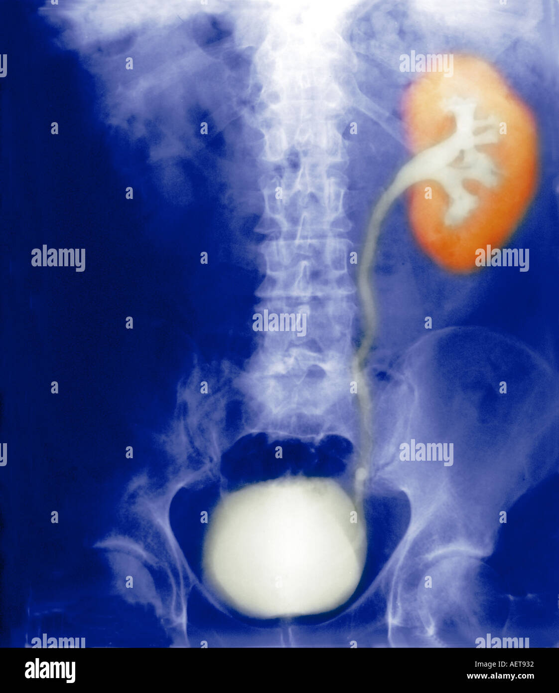 Xray of bladder hi-res stock photography and images - Alamy
