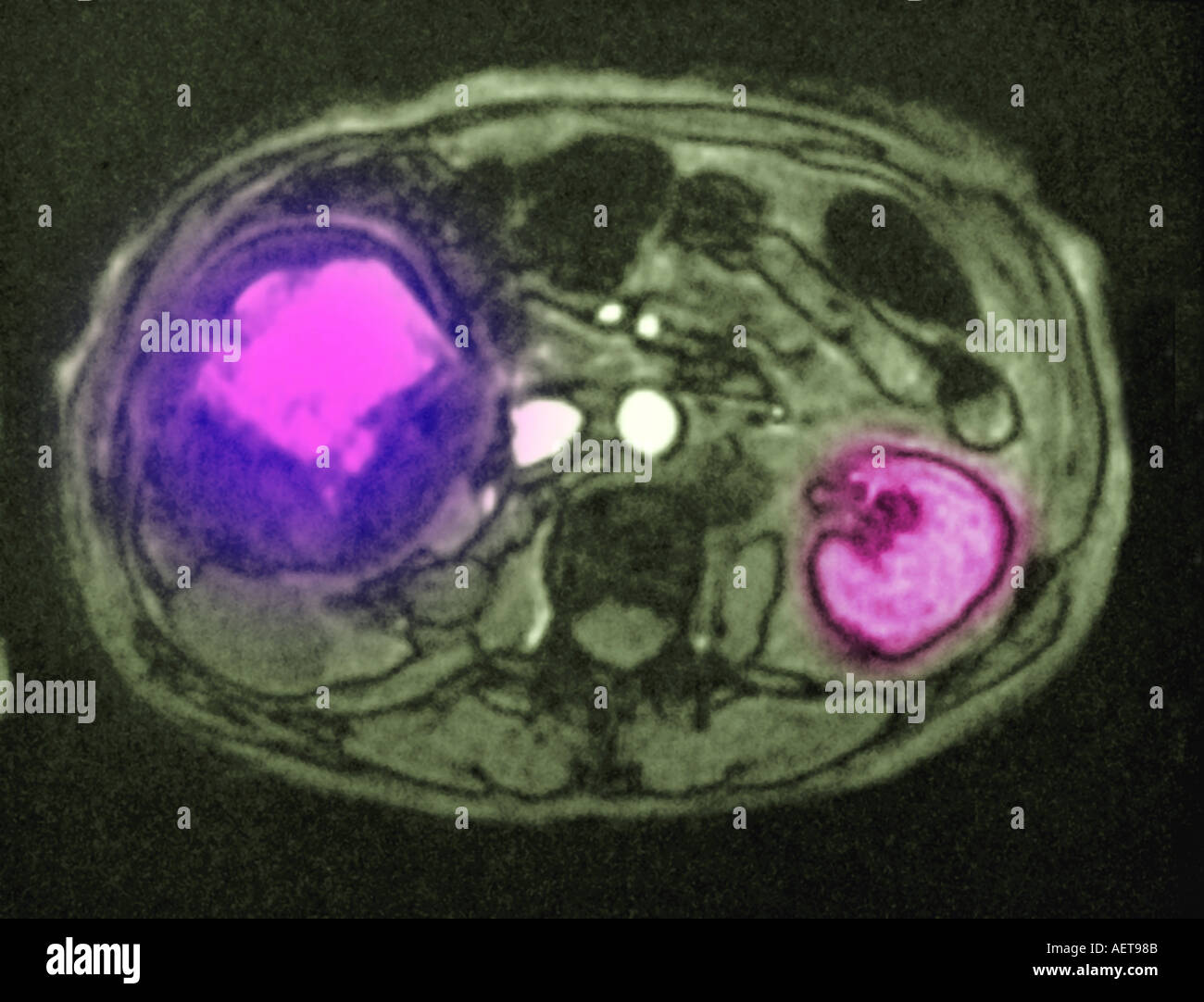 Kidney tumor mri scan hi-res stock photography and images - Alamy