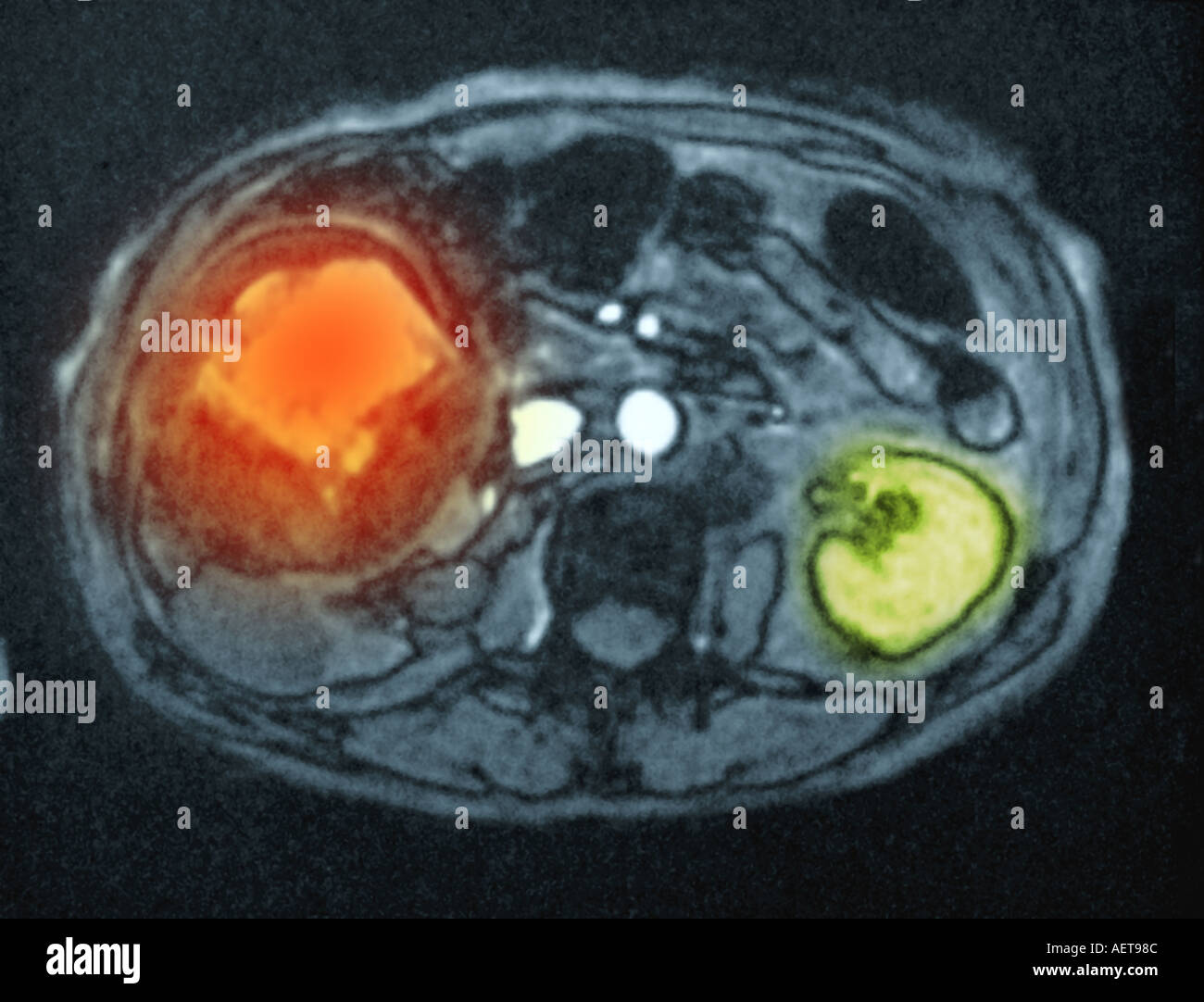 Renal cell carcinoma of the kidney as seen in an MRI scan of a 73 year ...