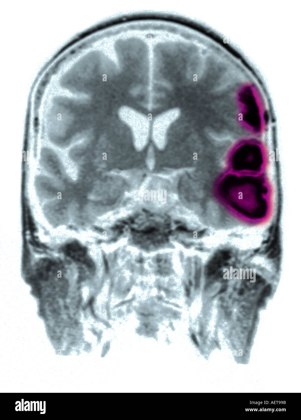 Temporoparietal brain hemorrhage in a 77 year old female shown on an ...