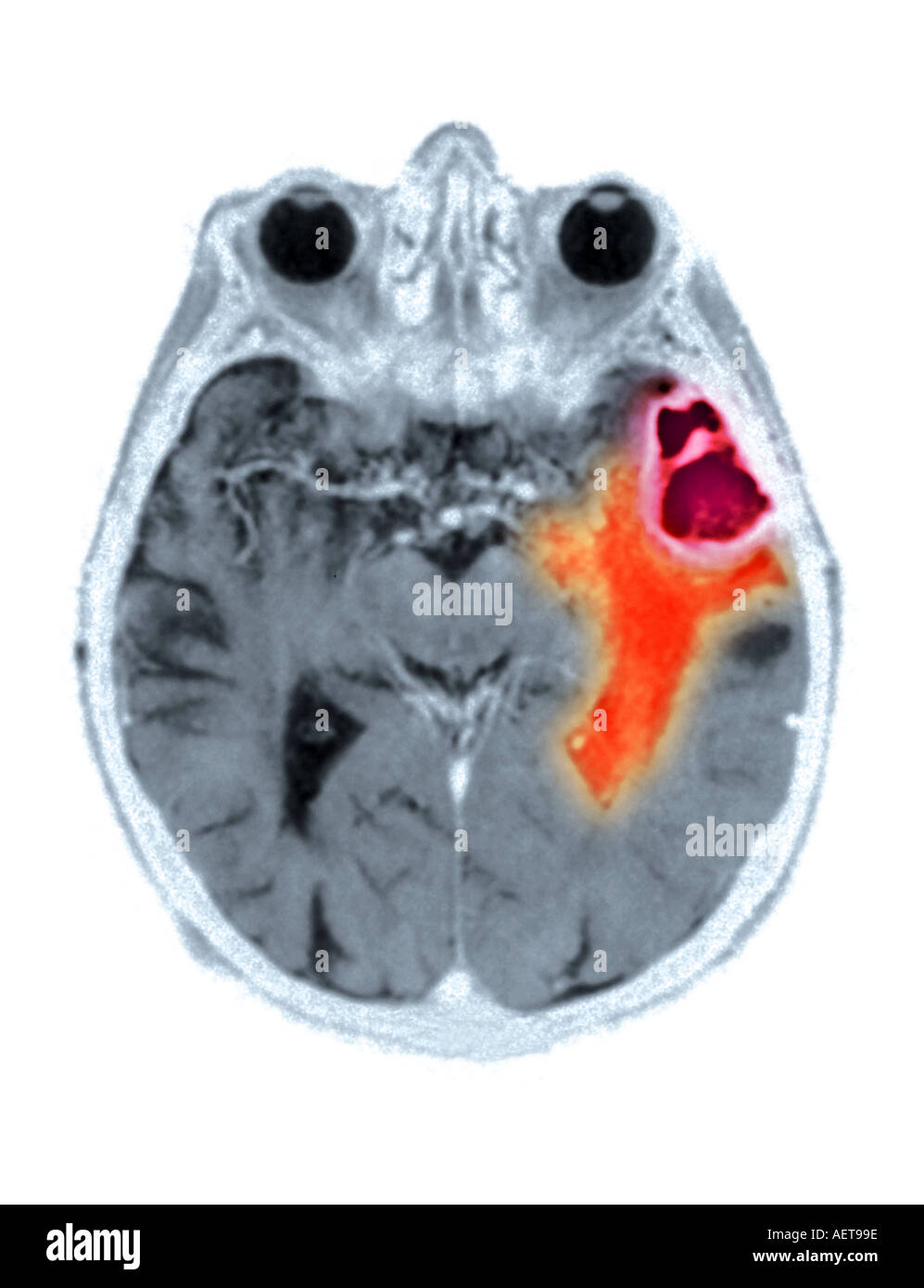 Temporoparietal brain hemorrhage in a 77 year old female shown on an ...