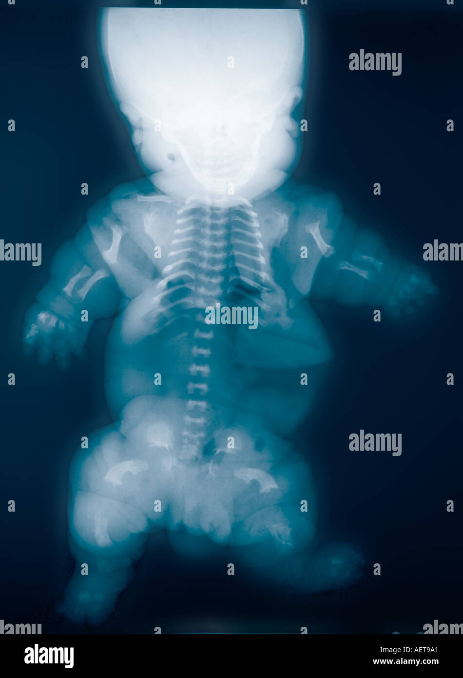 xray of a baby showing dwarfism Stock Photo - Alamy