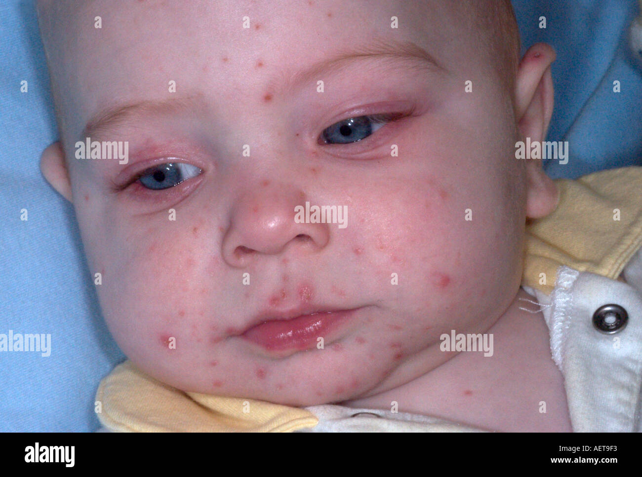 Chicken pox rash on face 6 days old Stock Photo - Alamy
