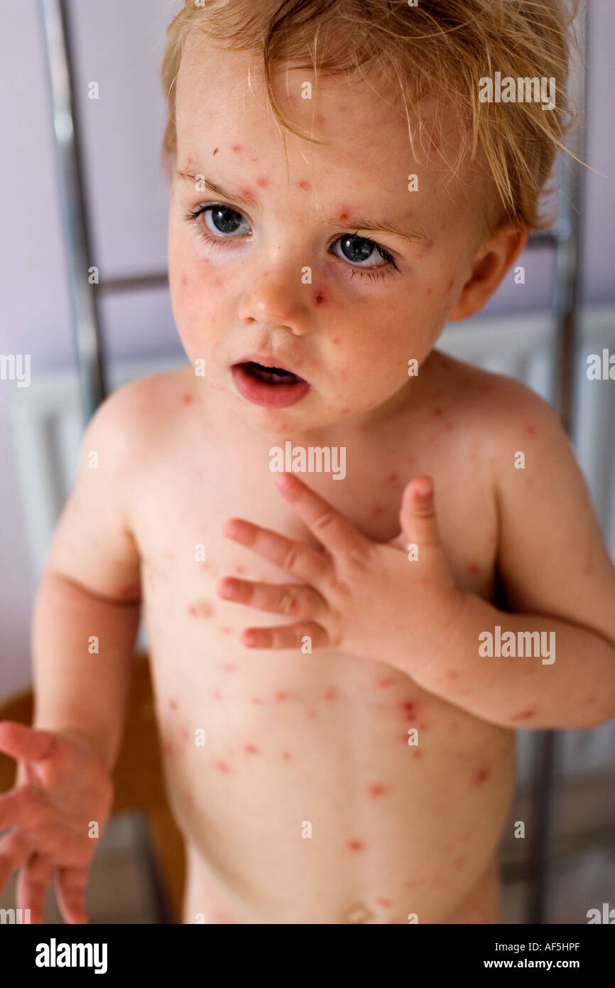 Boy with chicken pox Stock Photo - Alamy