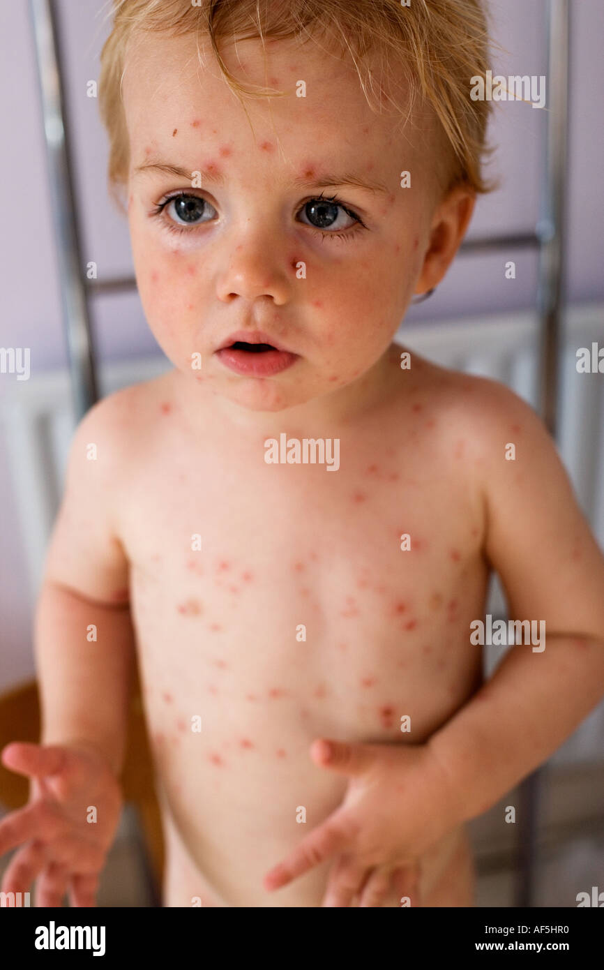 Chicken pox shingles hi-res stock photography and images - Alamy