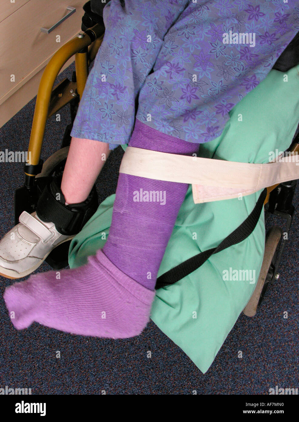 plastered foot and leg being supported by a pillow following an ...