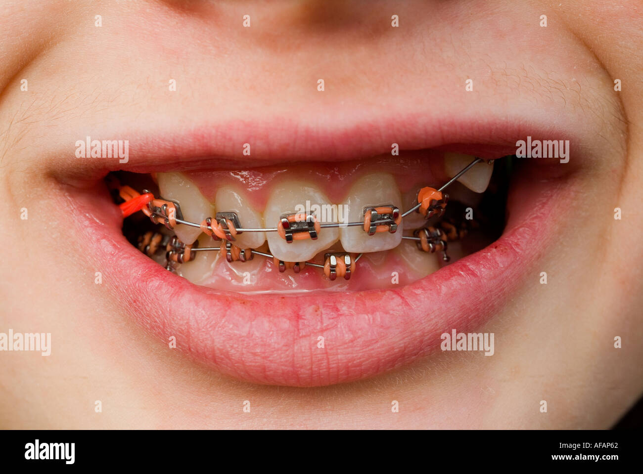 Dental braces fitted on boy s teeth Stock Photo - Alamy