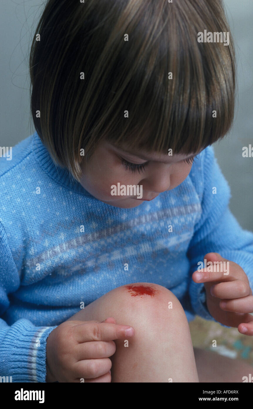 Grazed knee hi-res stock photography and images - Alamy