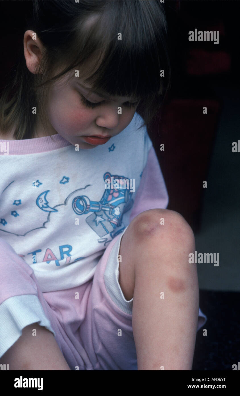 Bruises hi-res stock photography and images - Alamy