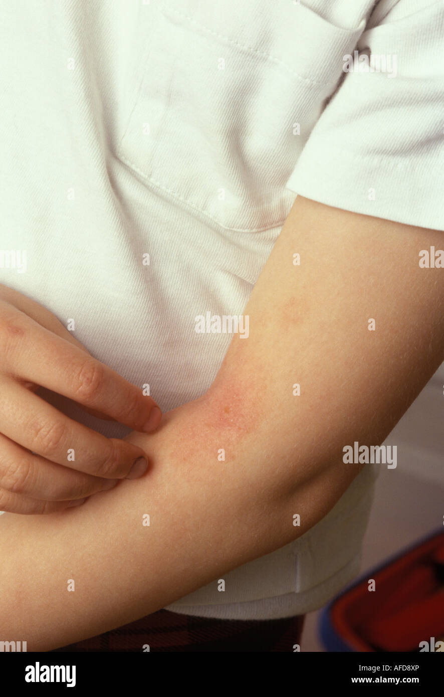 close ups of hands scratching eczema Stock Photo - Alamy