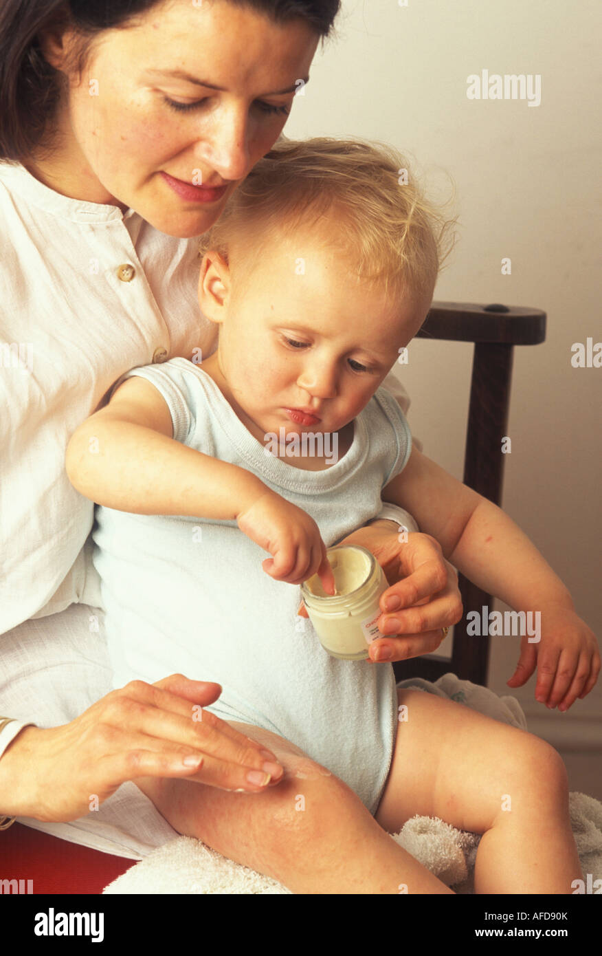 mother putting cream onto her child s eczema Stock Photo - Alamy