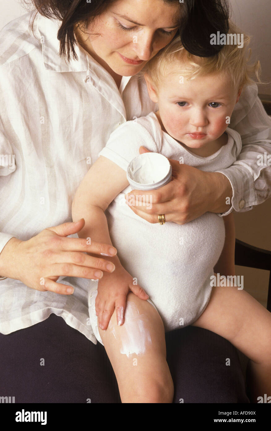 mother putting cream onto her child s eczema Stock Photo - Alamy