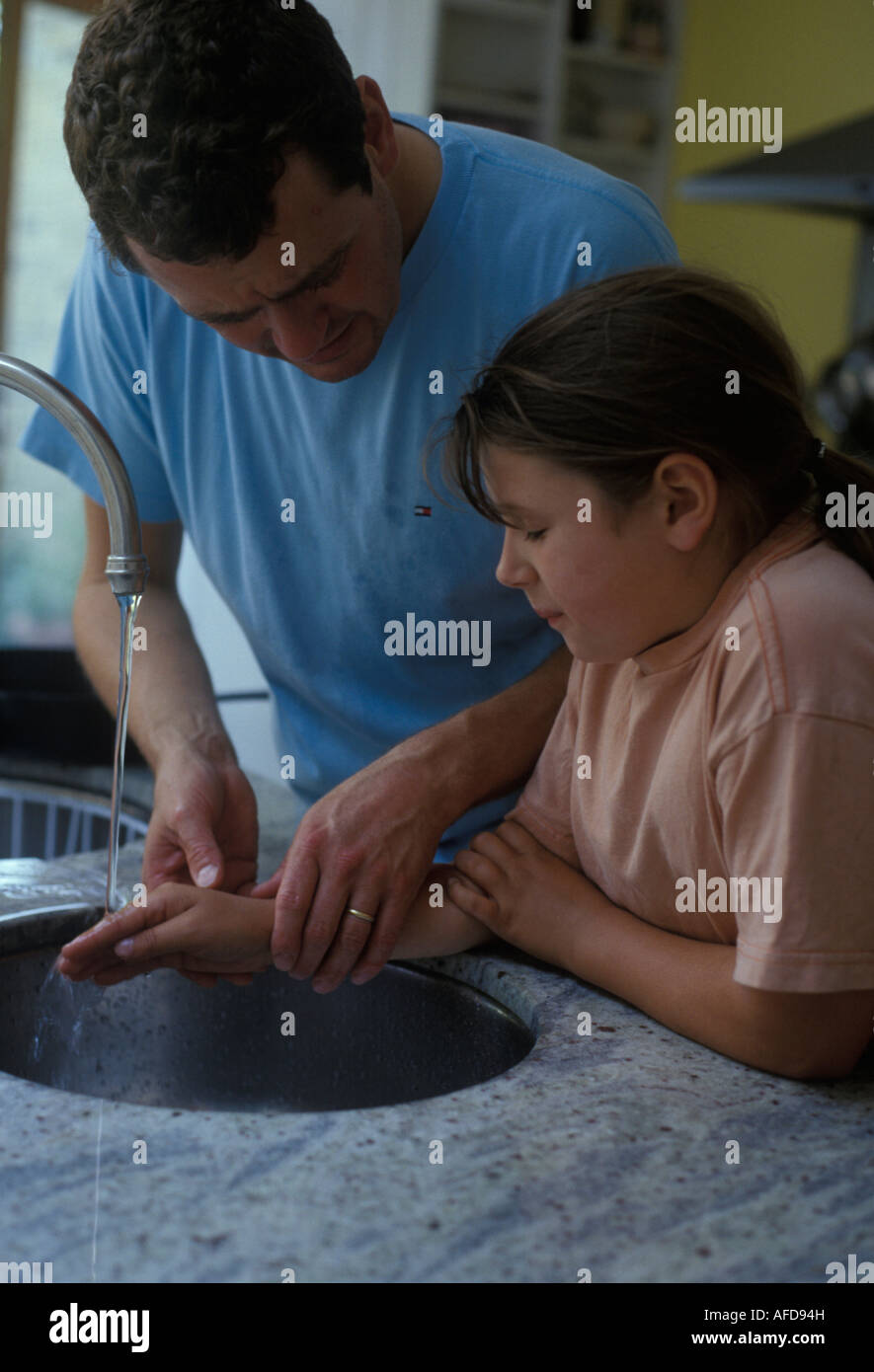 Scalded child hand hi-res stock photography and images - Alamy
