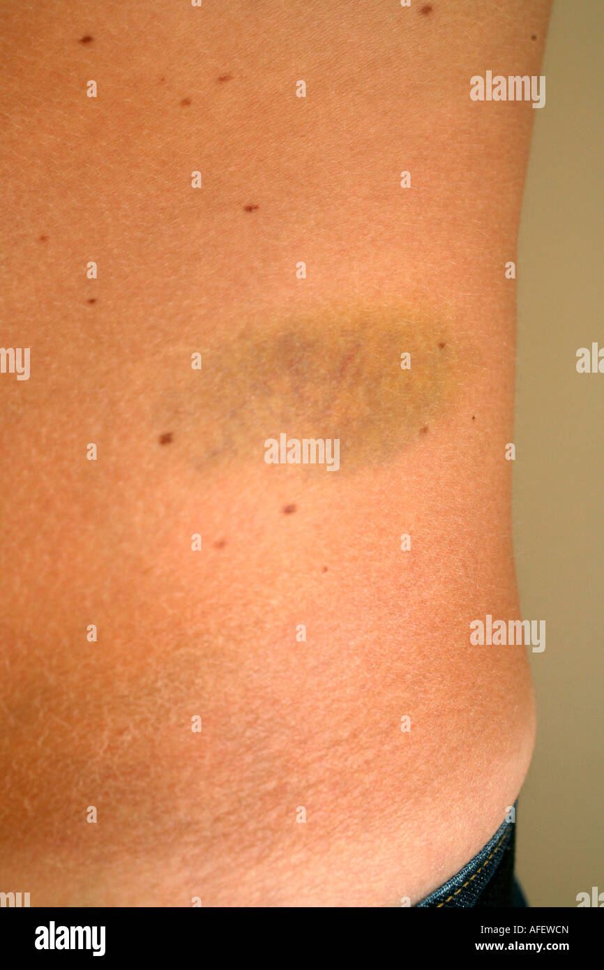 Young adut male with bruise Stock Photo - Alamy