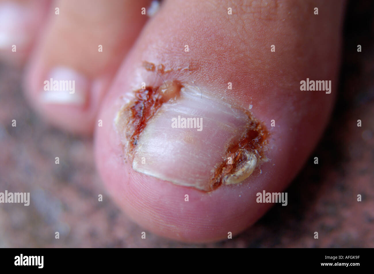 Inflammed big toe hi-res stock photography and images - Alamy
