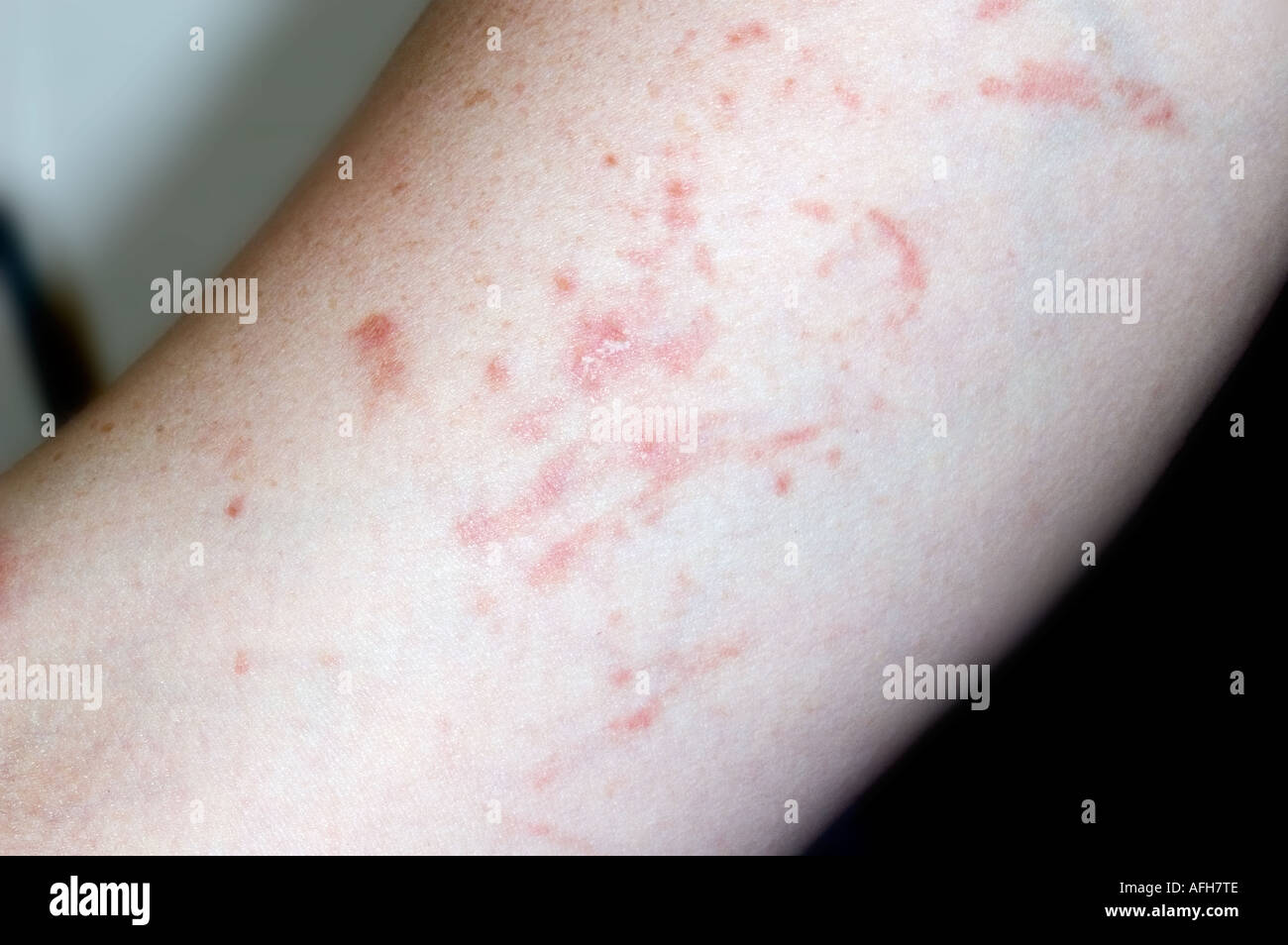 Eczema showing the Koebner Phenomenon Stock Photo - Alamy