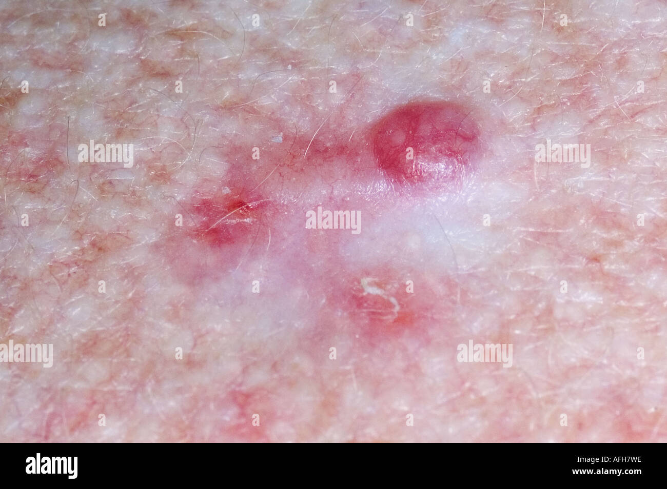 Nodular basal cell carcinoma hi-res stock photography and images - Alamy