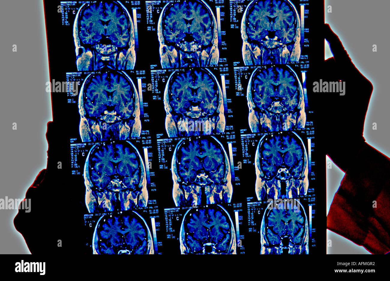 doctor examining x-rays of cerebral cortex cerebellum human brain Stock ...