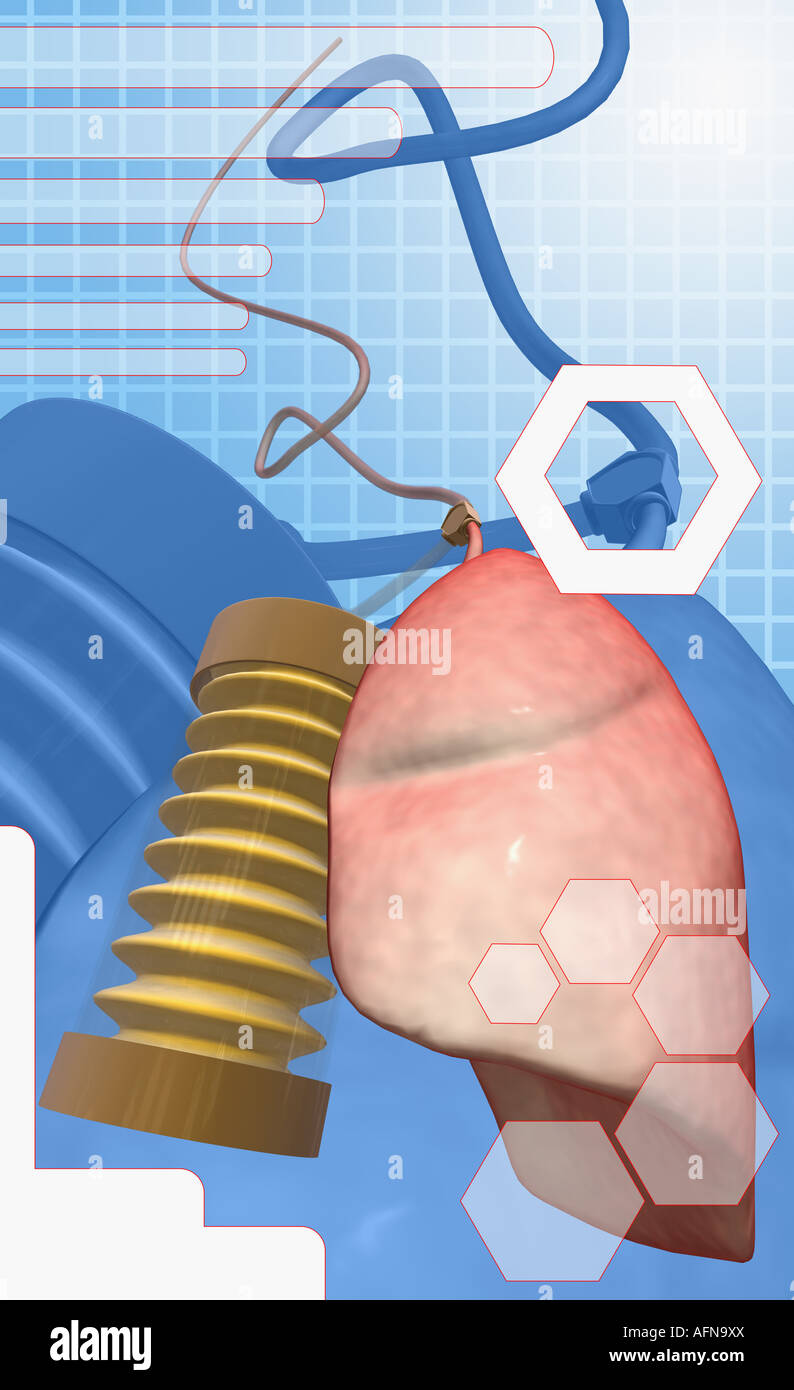 Artificial kidney hi-res stock photography and images - Alamy