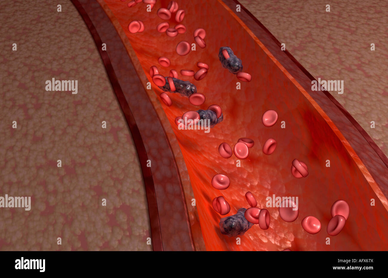 Bacterial blood infection Stock Photo - Alamy