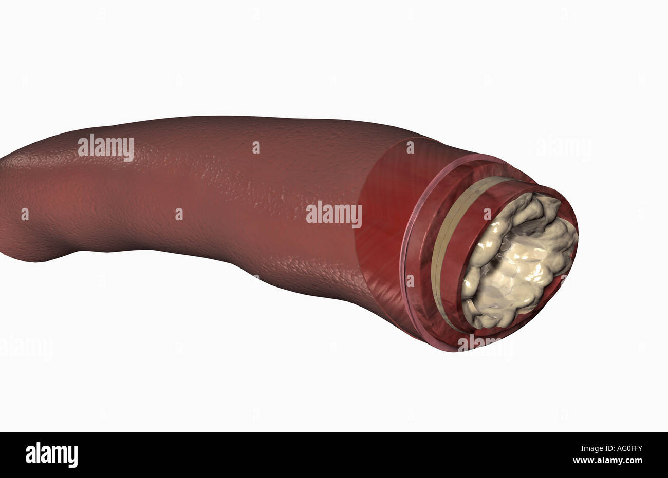 Clogged Artery Stent High Resolution Stock Photography and Images - Alamy