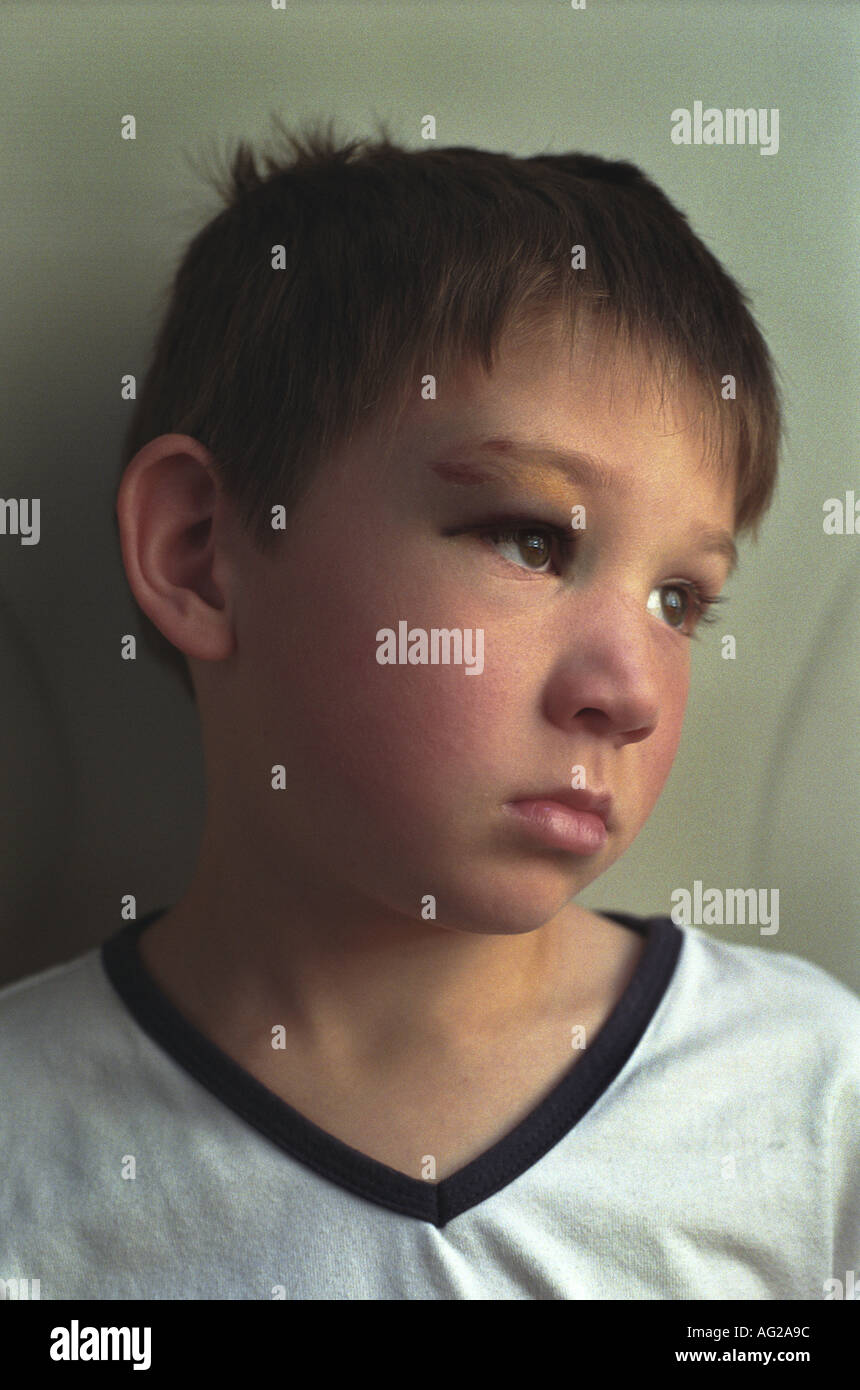 Boy with black eye London England Stock Photo - Alamy