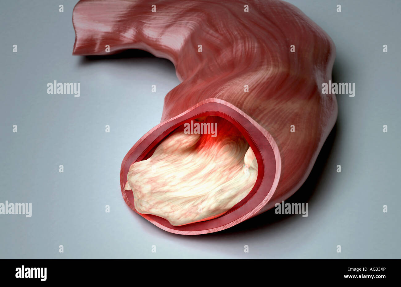 Aorta plaque hi-res stock photography and images - Alamy