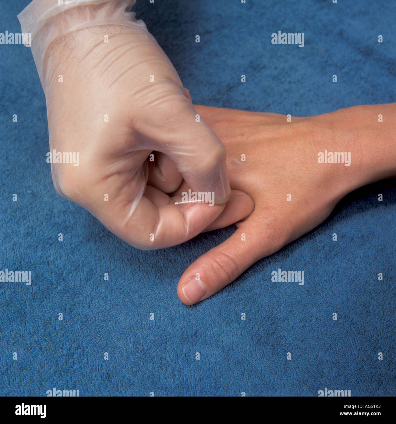 Hand with a acupuncture needle performs acupuncture in a hand Stock ...