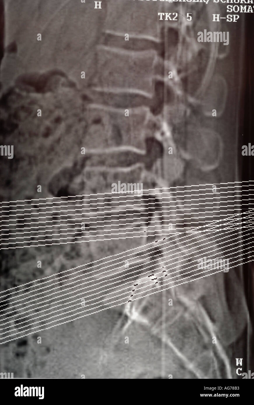 Spinal marrow hi-res stock photography and images - Alamy