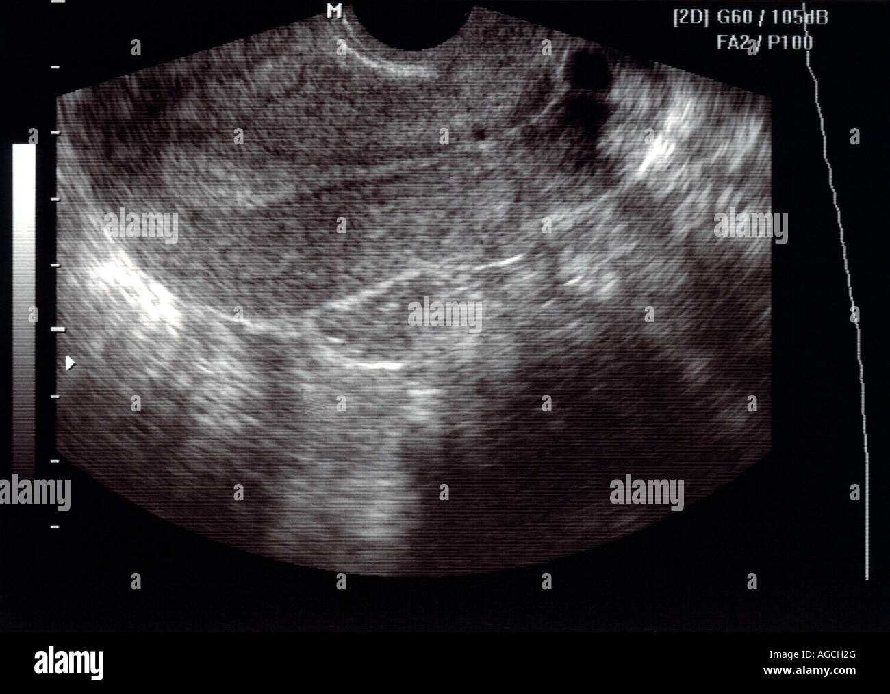 Vaginal sonography showing an uterus with Naboth cysts on its cervix ...
