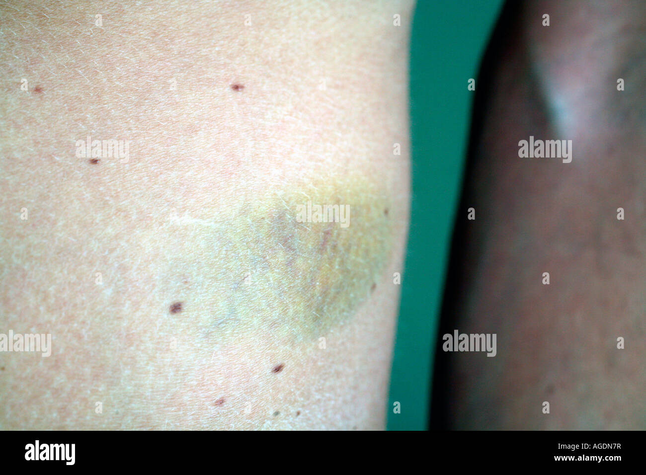 Bruising stomach hi-res stock photography and images - Alamy