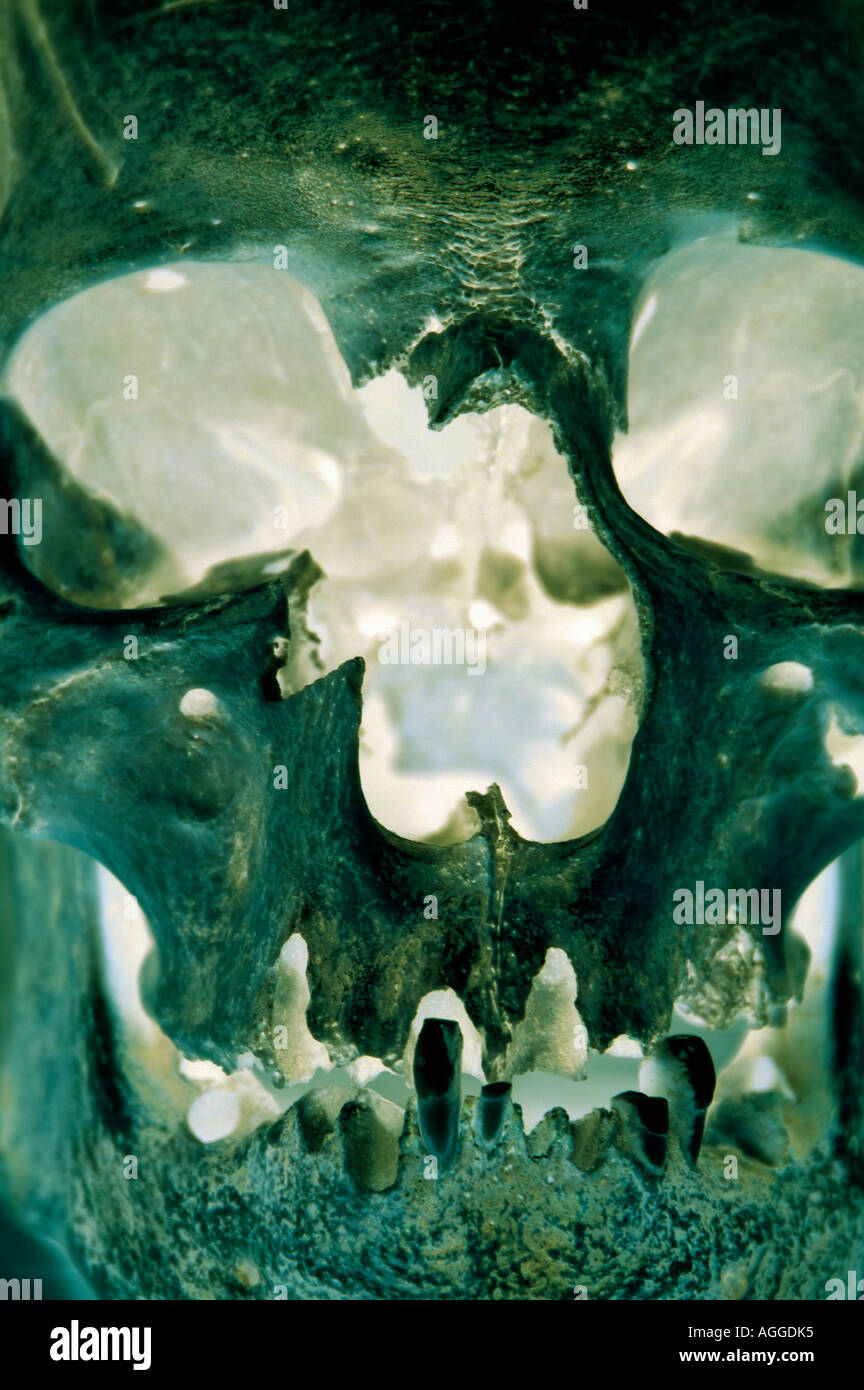 detail of a human scull (lit from interior) of a murder victim in a ...
