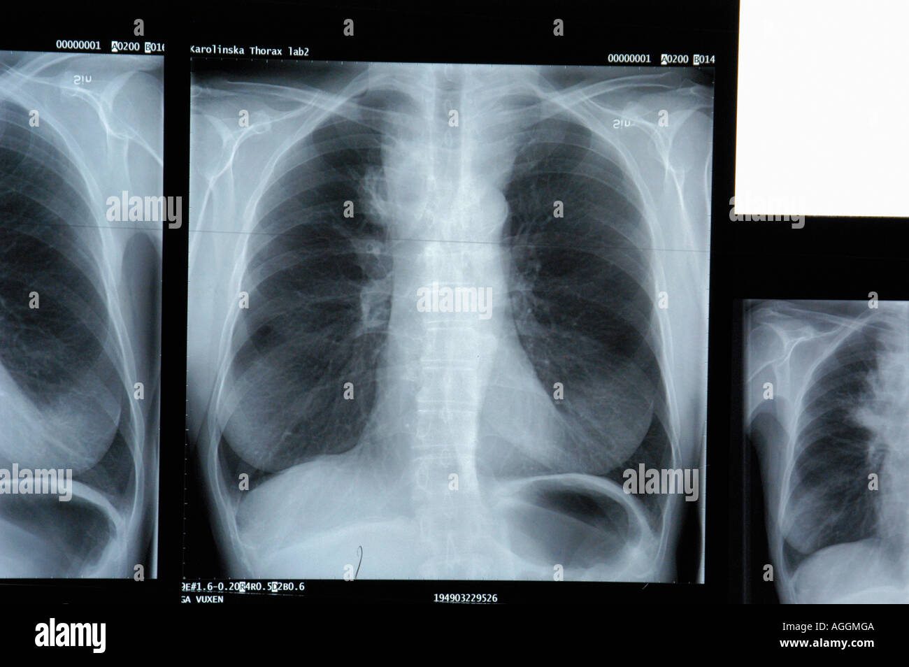 x-ray plate of human lungs, screening lung cancer Stock Photo - Alamy