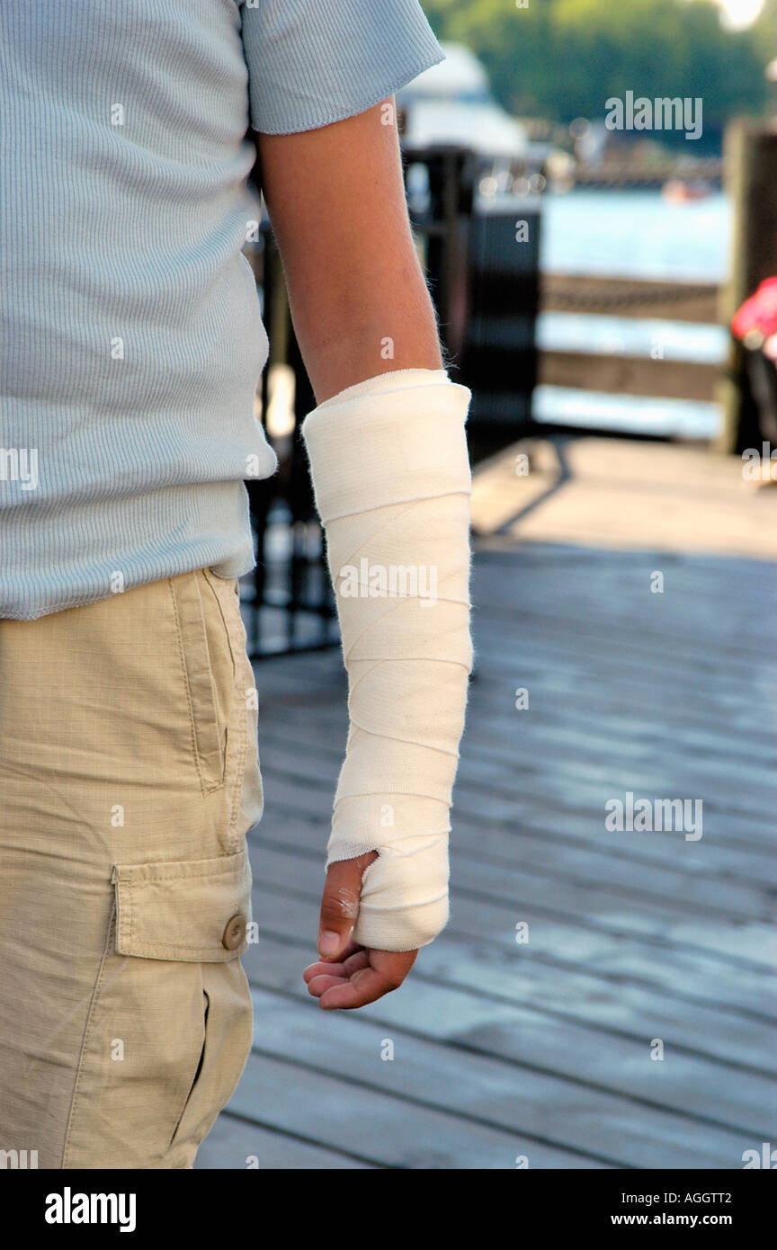 plaster bandage around a fractured arm Stock Photo - Alamy
