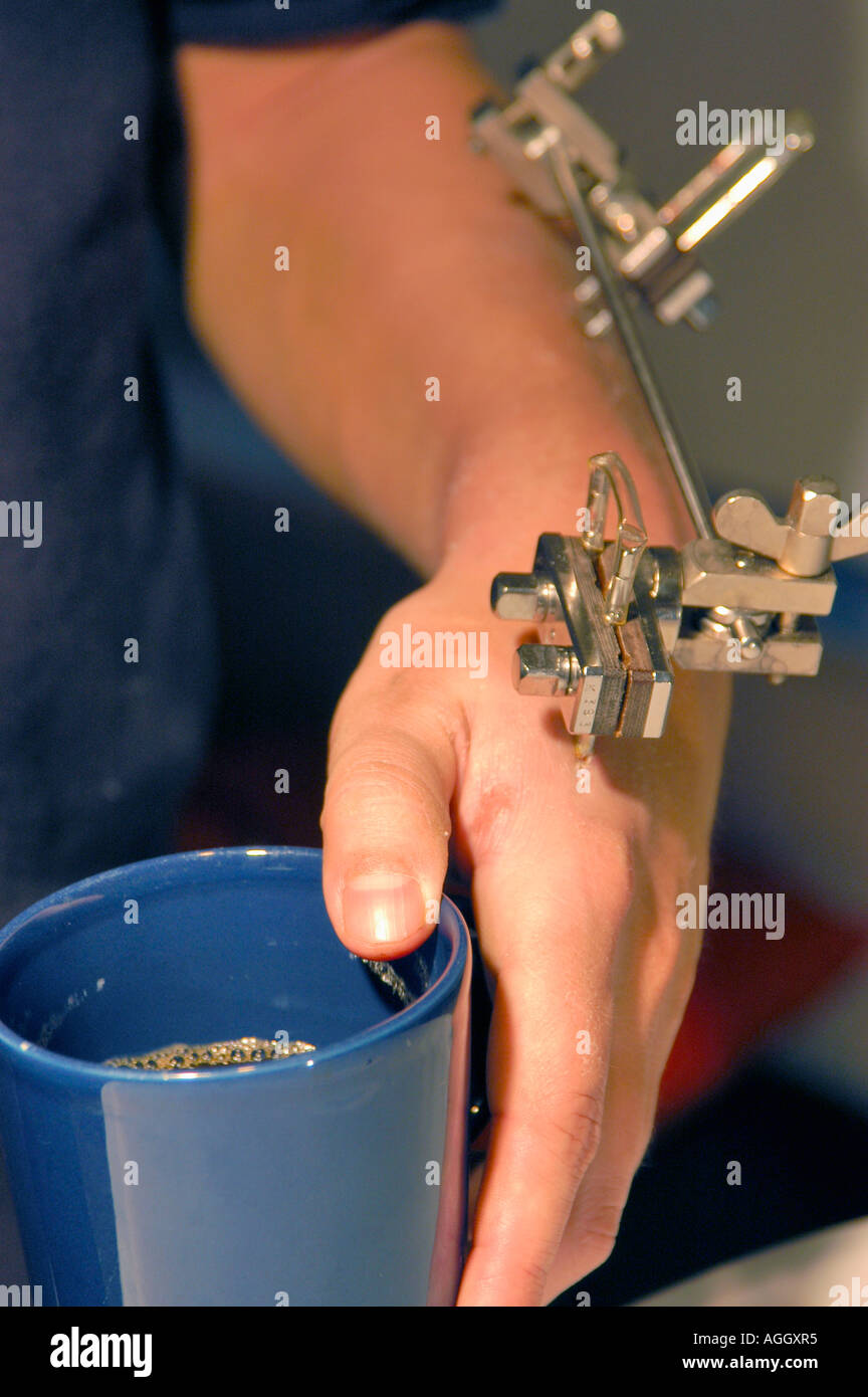 healing arm fracture Stock Photo - Alamy