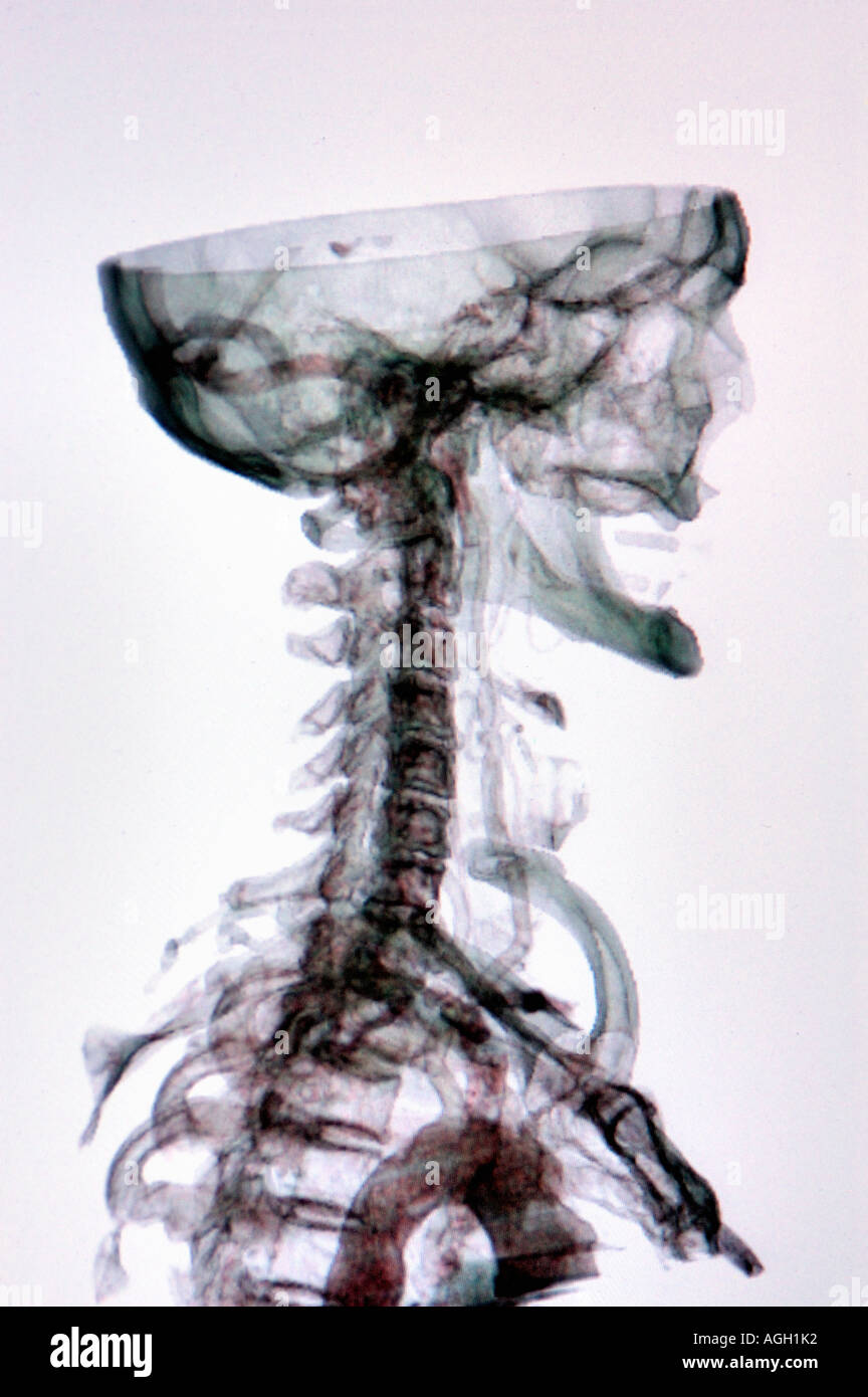 MRI-image in 3D of a human (Magnetic Resonance Imaging Stock Photo - Alamy