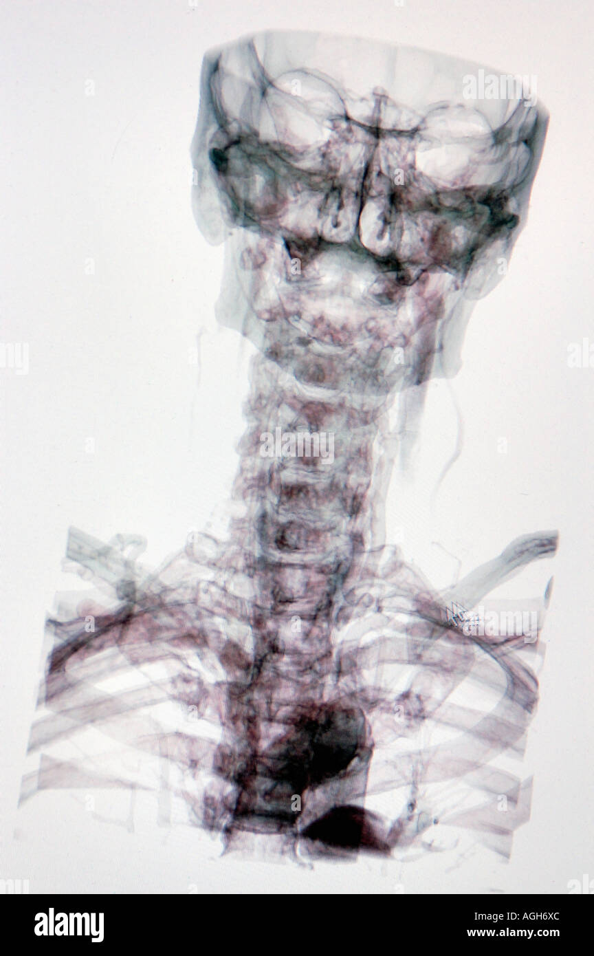 Mri scan backbone hi-res stock photography and images - Alamy