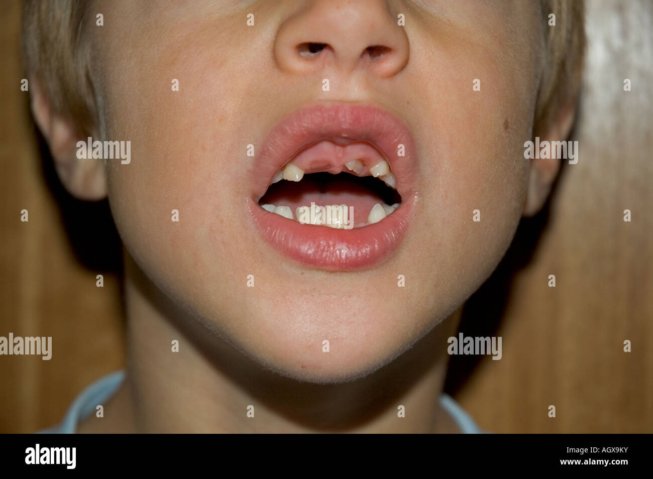 Rotten teeth child hi-res stock photography and images - Alamy