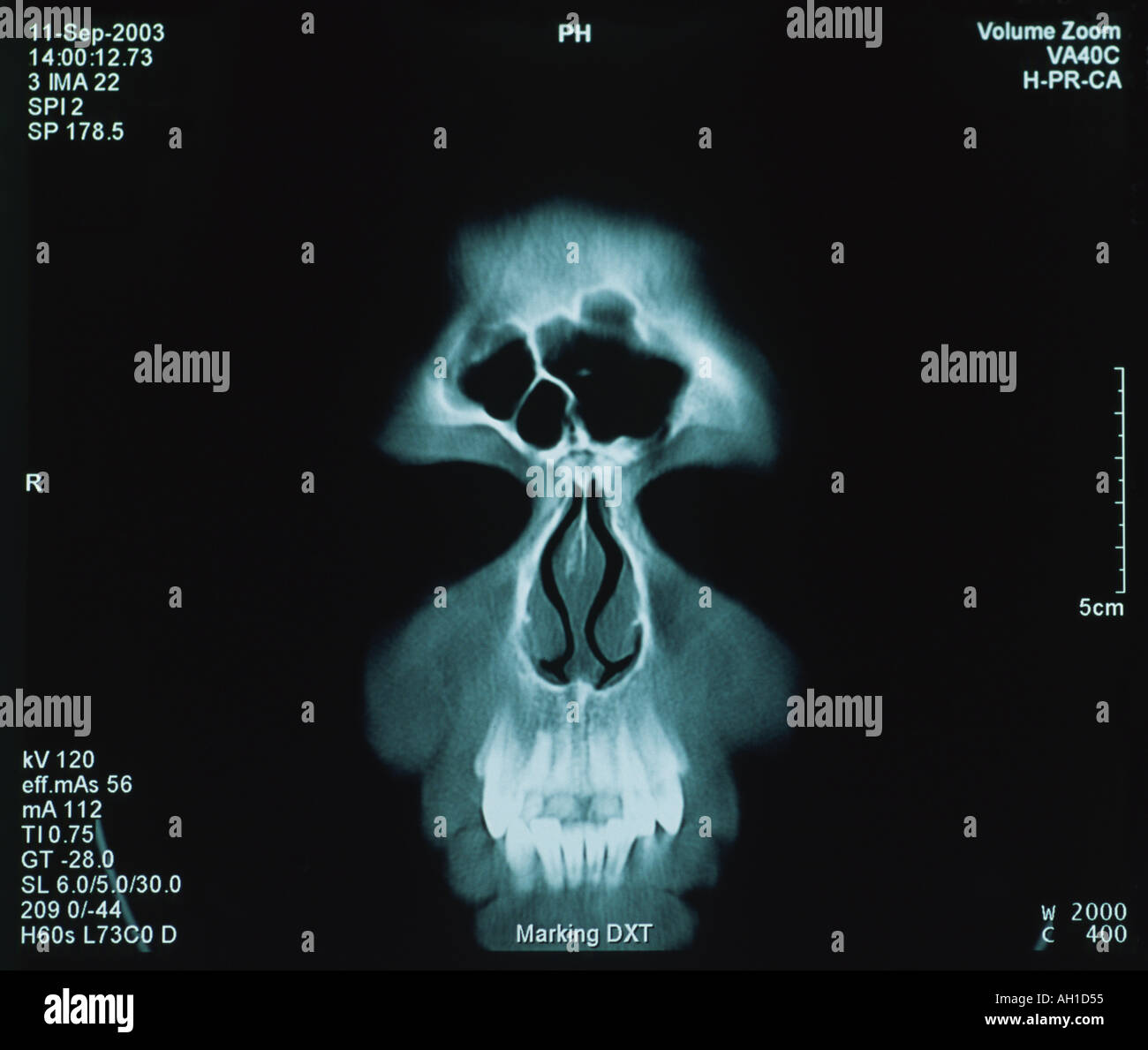 Skull and molars hi-res stock photography and images - Alamy