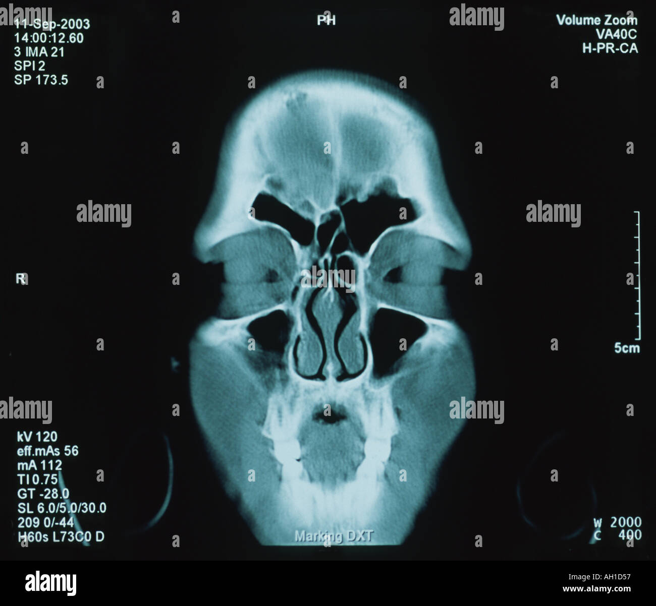 Skull and molars hi-res stock photography and images - Alamy