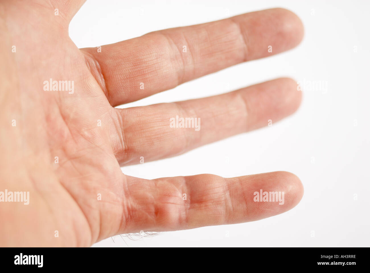 Dupuytrens contracture 12 months after corrective surgery Stock Photo ...