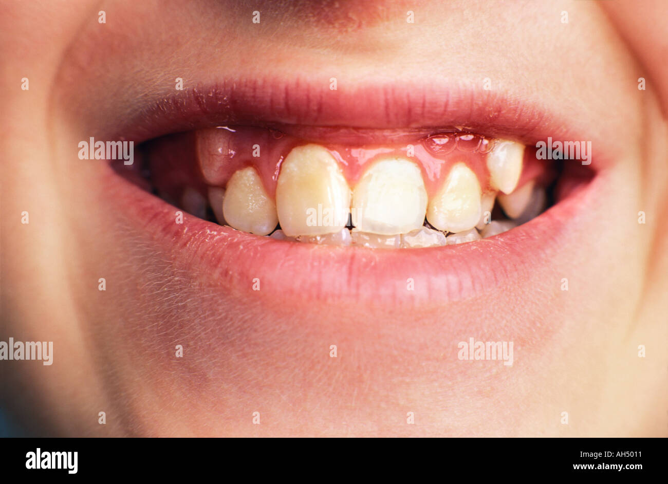YOUNG BOY S TEETH Stock Photo - Alamy