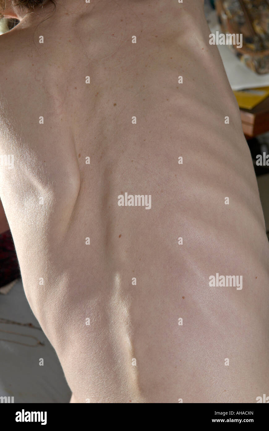 Anorexia ribs hi-res stock photography and images - Alamy