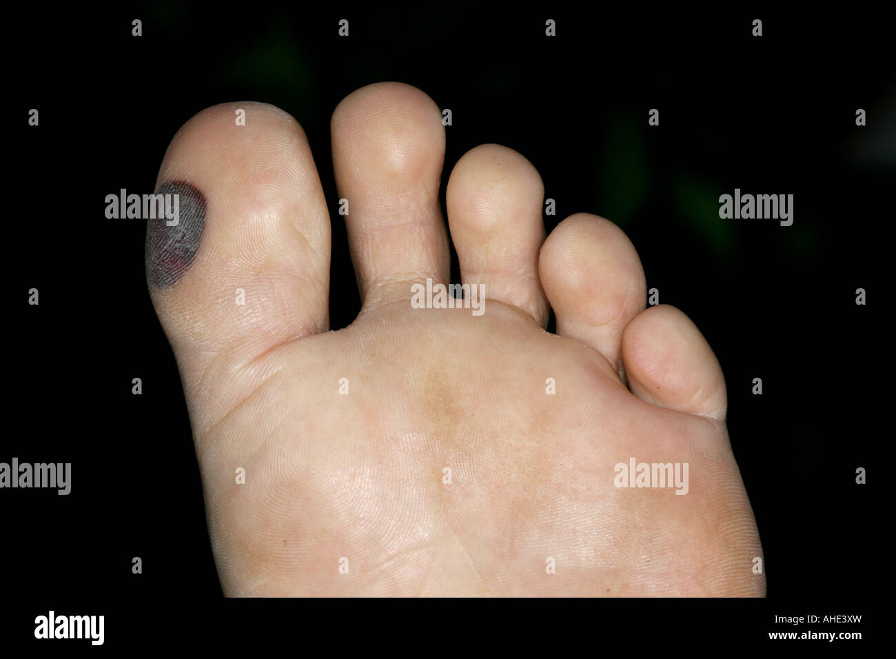 Sore under a toe with blood in it Stock Photo - Alamy